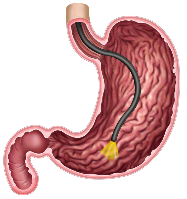 Gastroscopy Procedure | My Gut Care