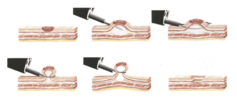 Endoscopic Mucosal Resection (EMR) | My Gut Care