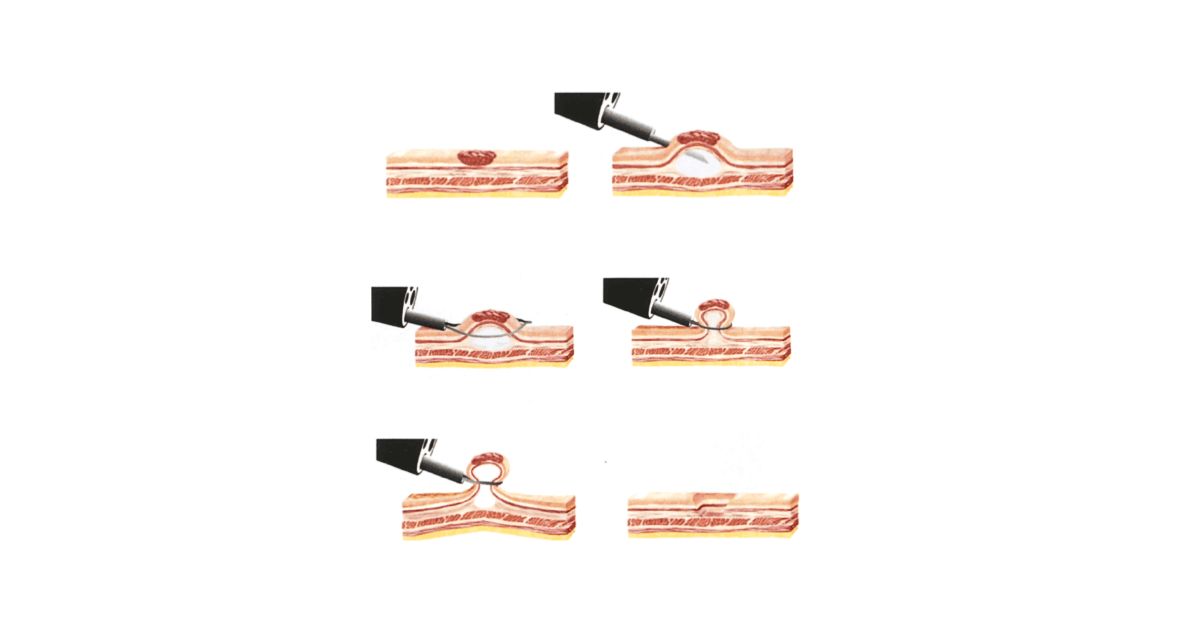 Endoscopic Mucosal Resection (EMR) | My Gut Care