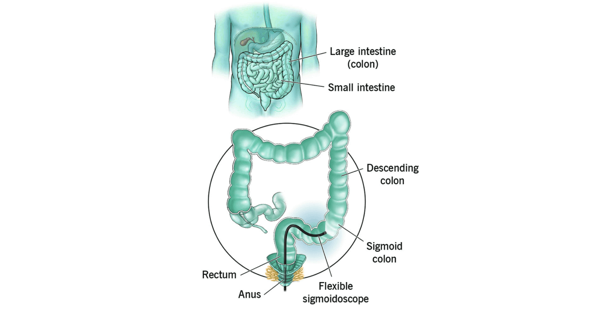 Flexible Sigmoidoscopy | My Gut Care